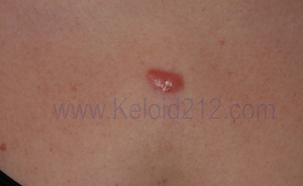 Chest Keloid1b Keloid Removal Expert New York