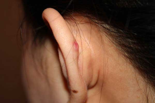 Ear Keloids - Ear Helix Keloid