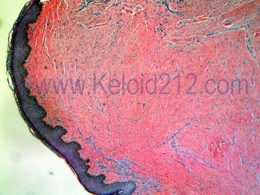 keloid-pathology1 - Keloid Removal Expert - New York