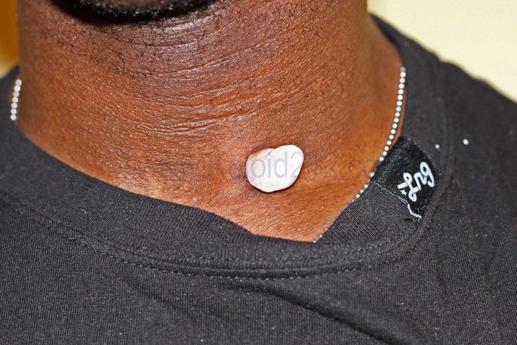 Neck Keloids - Tumoral Neck Keloid