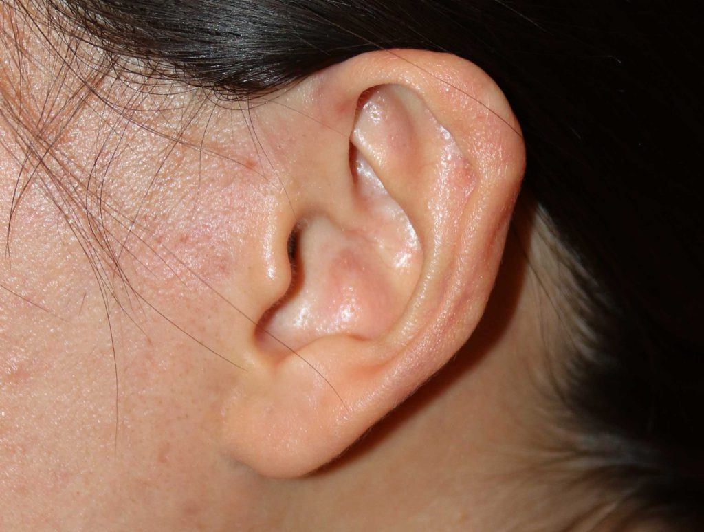 Ear Helix Keloid Treatment Result - Keloid Removal Expert - New York