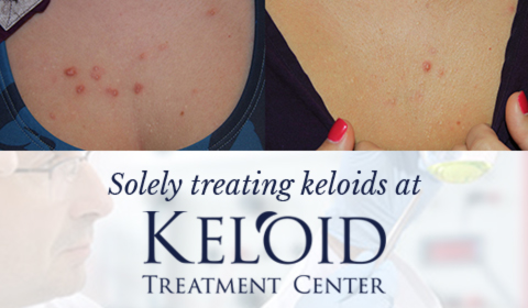 Keloid Specialist, Keloid Removal Expert, Keloid Treatment, New York