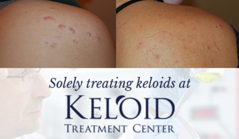Keloid Specialist, Keloid Removal Expert, Keloid Treatment, New York