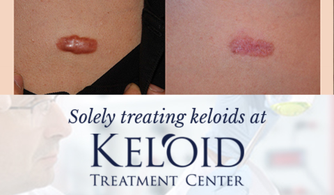 Keloid Specialist, Keloid Removal Expert, Keloid Treatment, New York