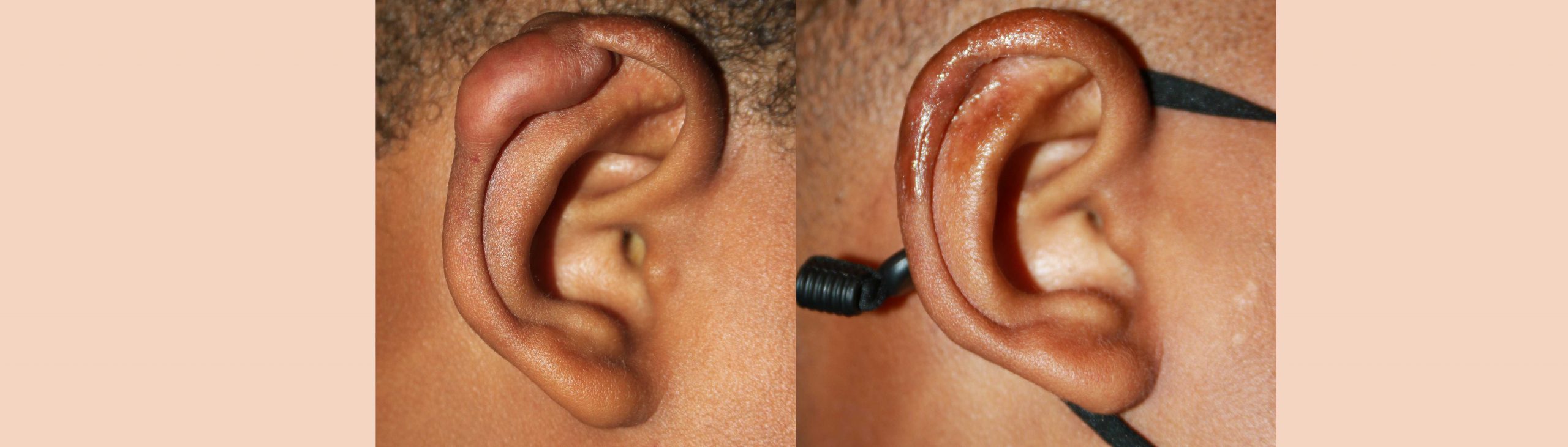 Keloid on ear, Earlobe Keloid Treatment - Non surgical