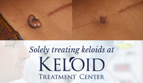 Keloid Specialist, Keloid Removal Expert, Keloid Treatment, New York