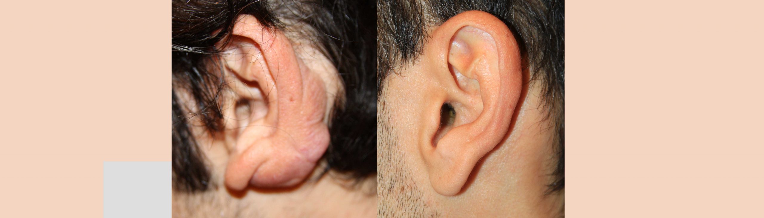 Otoplasty keloids - Posterior Auricular Keloids