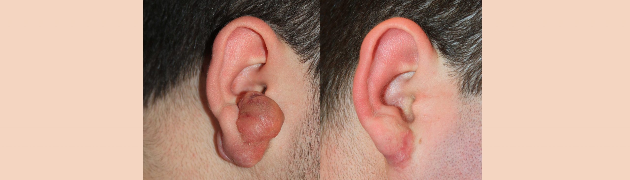 Keloid on ear, Earlobe Keloid Treatment - Non surgical