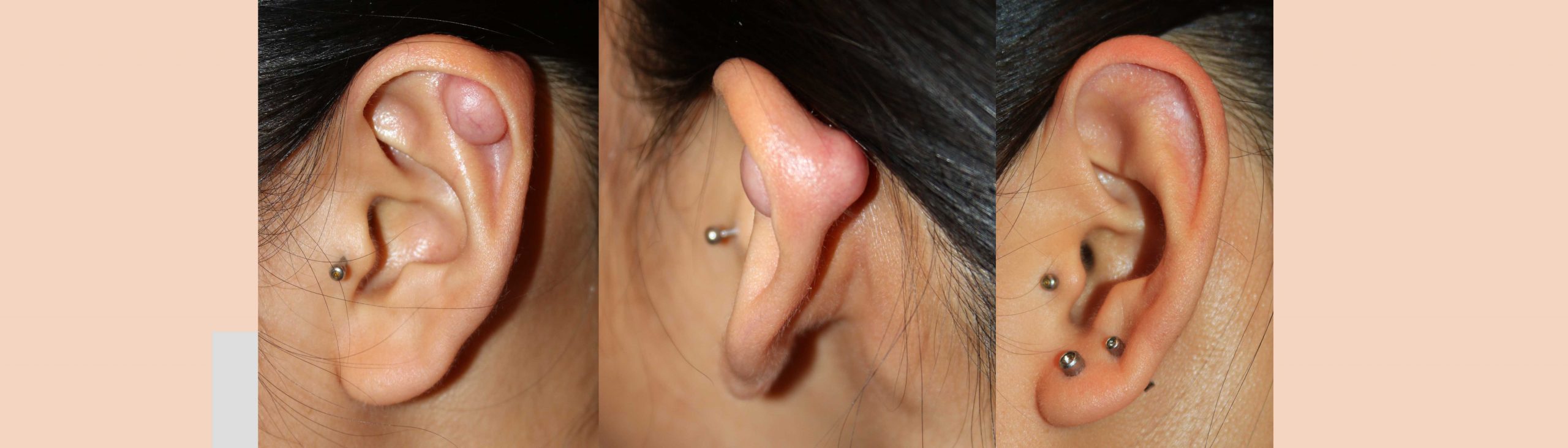 Keloid on ear, Earlobe Keloid Treatment - Non surgical