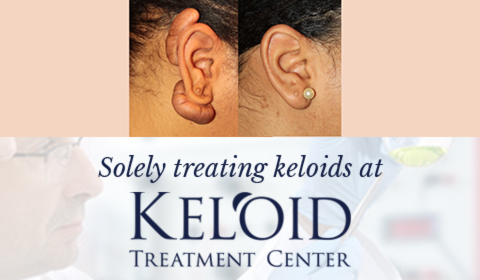Keloid Specialist, Keloid Removal Expert, Keloid Treatment, New York