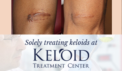 Keloid Specialist, Keloid Removal Expert, Keloid Treatment, New York