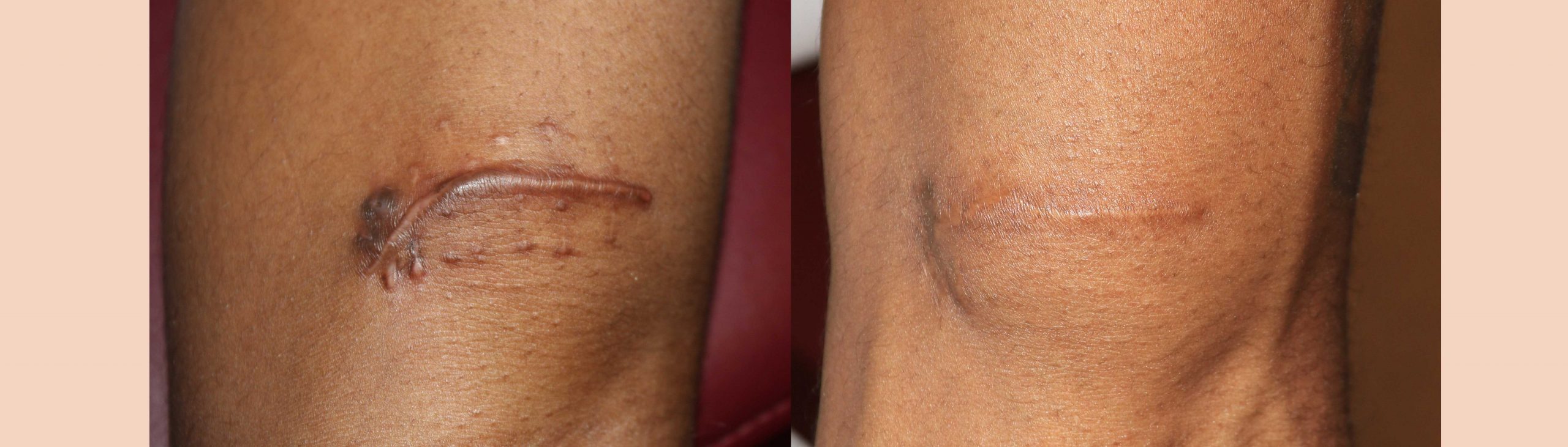 Keloid Specialist, Keloid Removal Expert, Keloid Treatment, New York