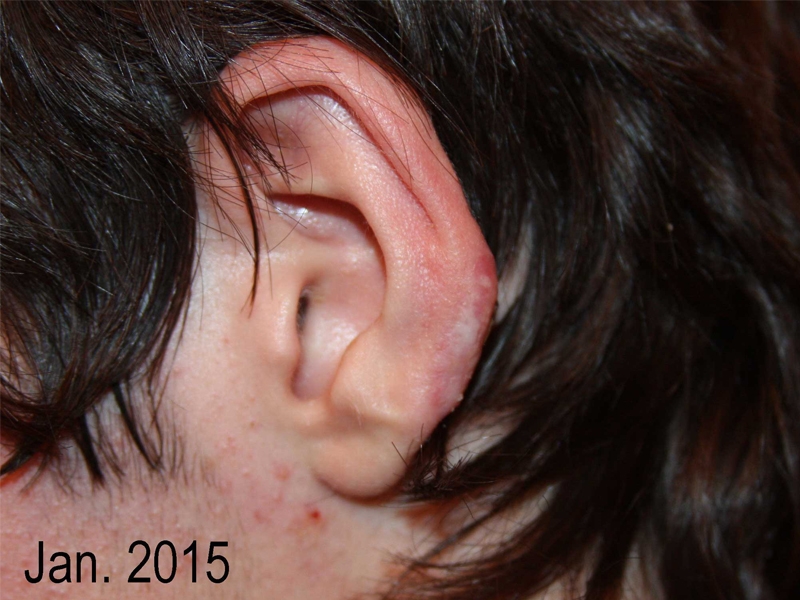 Ear keloids in teenagers - best treatment for teenage keloids