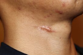 Neck Keloids - General Information