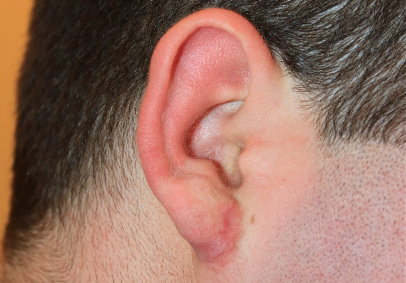 Complex Earlobe Keloid - Treatment with Cryotherapy