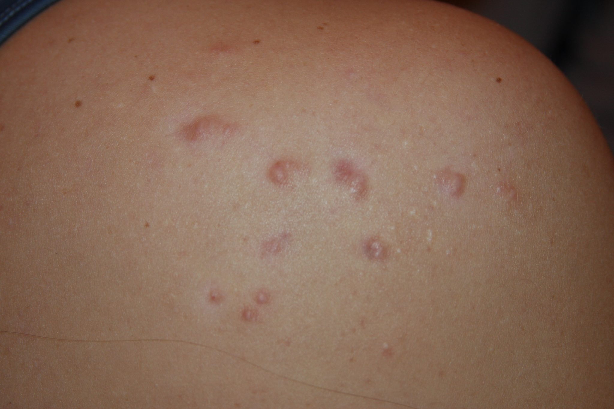 Multifocal acne-induced shoulder keloids