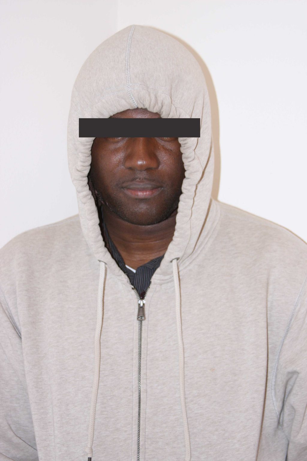 Facial Keloid treatment Results - Keloid Specialist In New York